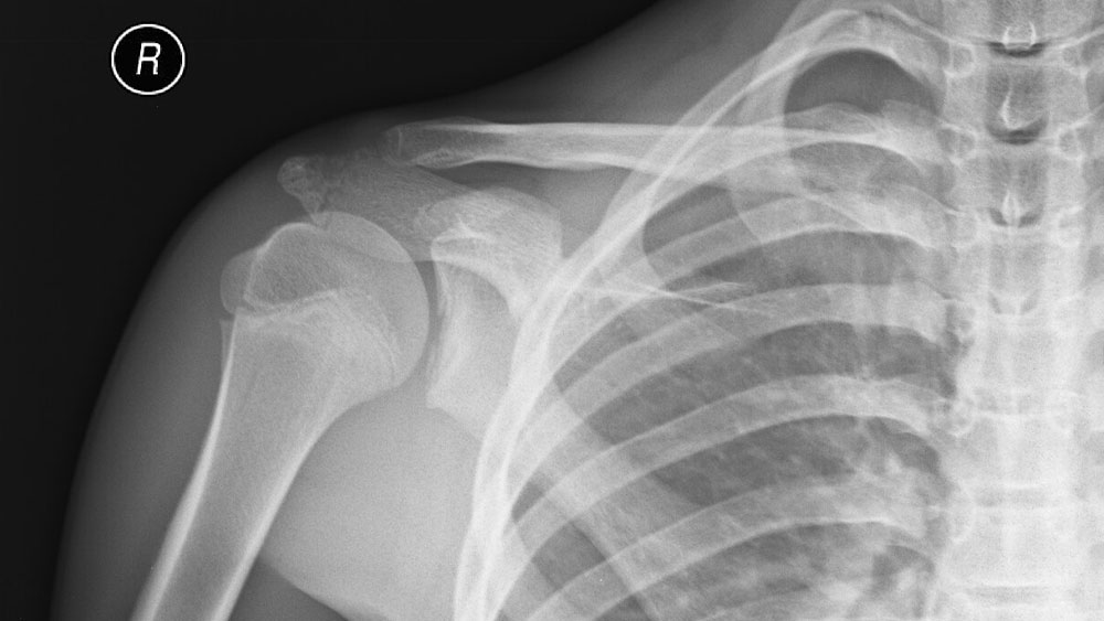 Do Ancient Fish Point to Shoulder Evolution? | The Institute for ...